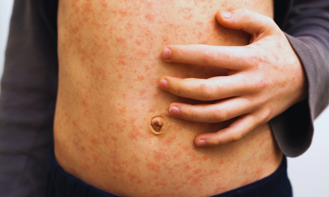 Fast In-House Mono Treatment | FamUrgent Care