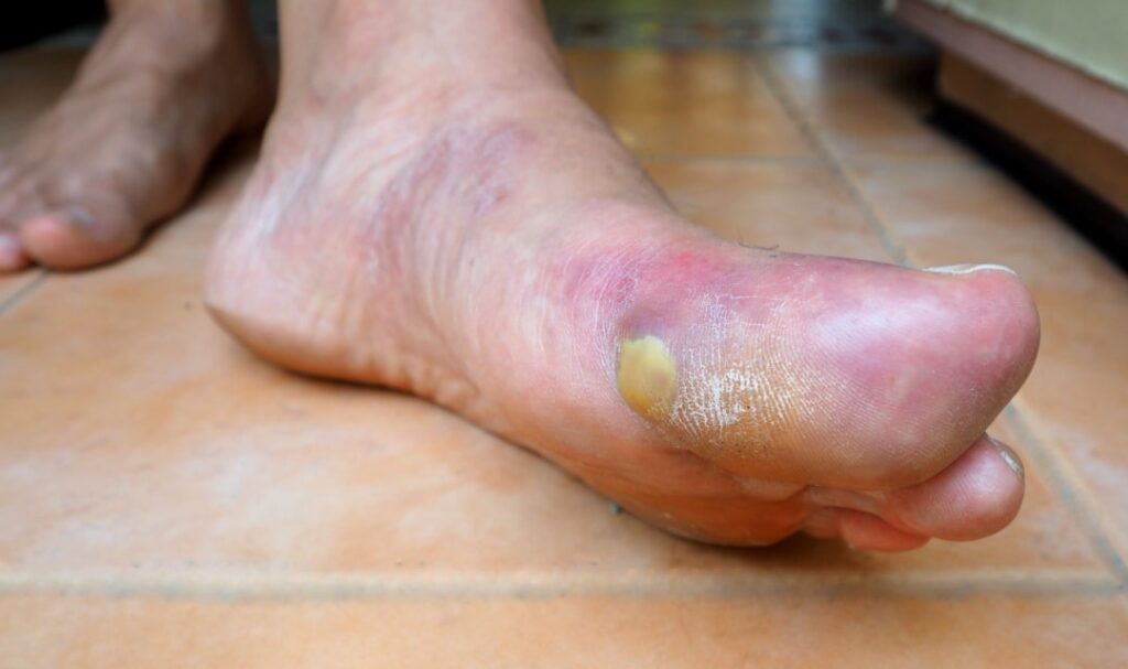 Expert Cyst & Abscess Removal At Family Urgent Care