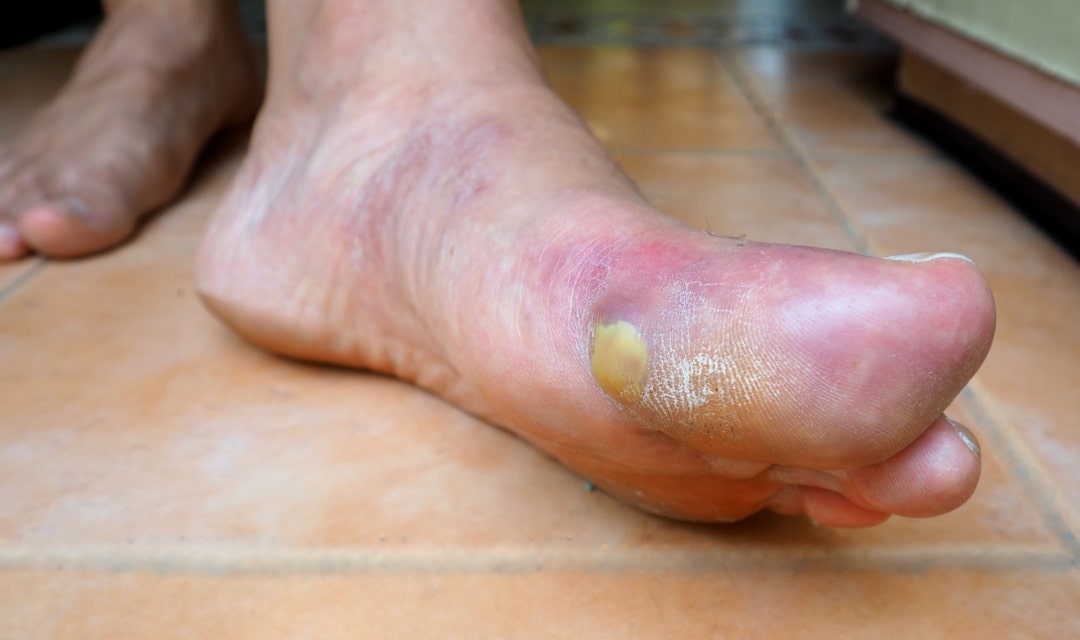 Abscess Cyst Urgent Care | Treatment & Drainage