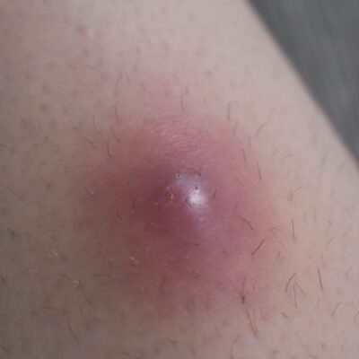 How Long Does An Abscess Take To Heal After Drainage? - Family Urgent Care