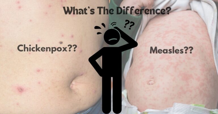 How Do I Differentiate Between Measles and Chicken Pox? - Family Urgent ...
